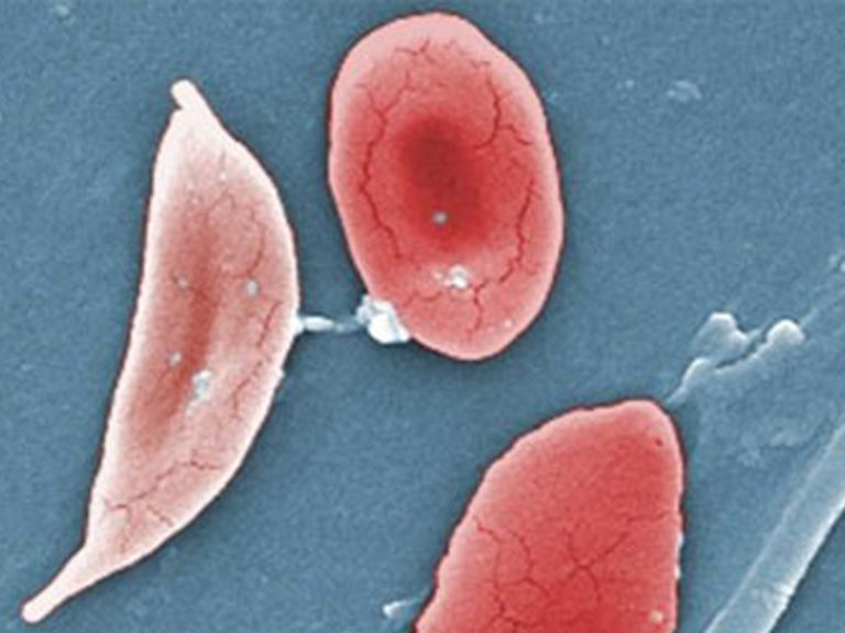 Diagnosis and prognosis for Sickle Cell Disease - The World of TCD ...
