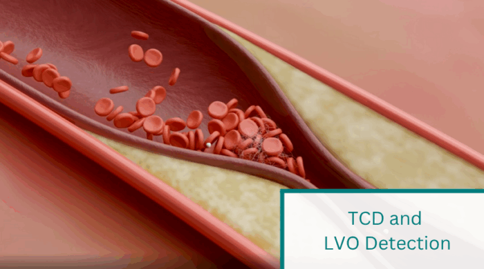 TCD and LVO Detection - The World of TCD Clinical Applications